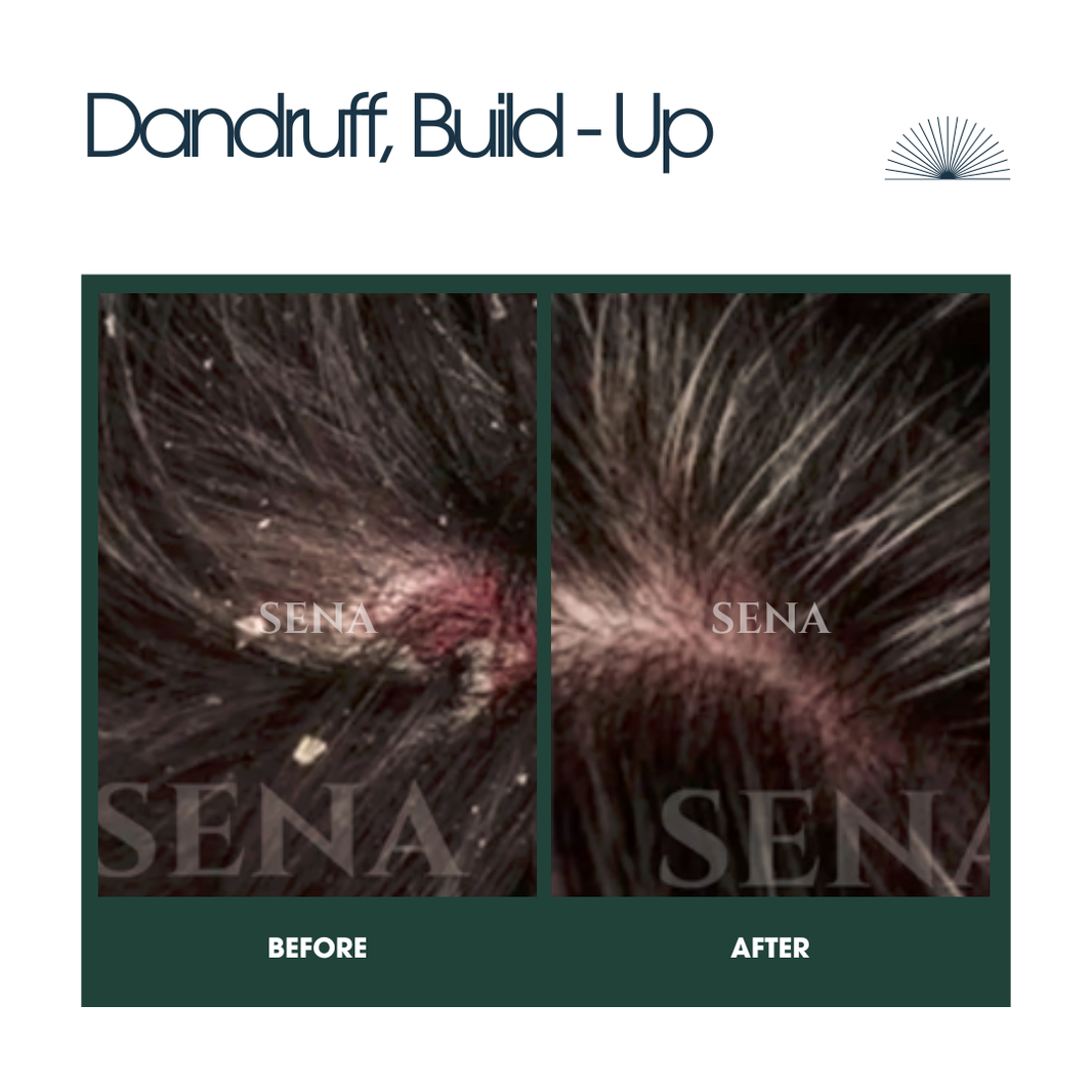 SENA Global — Scalp-First Hair Recovery for 150K+ Customers